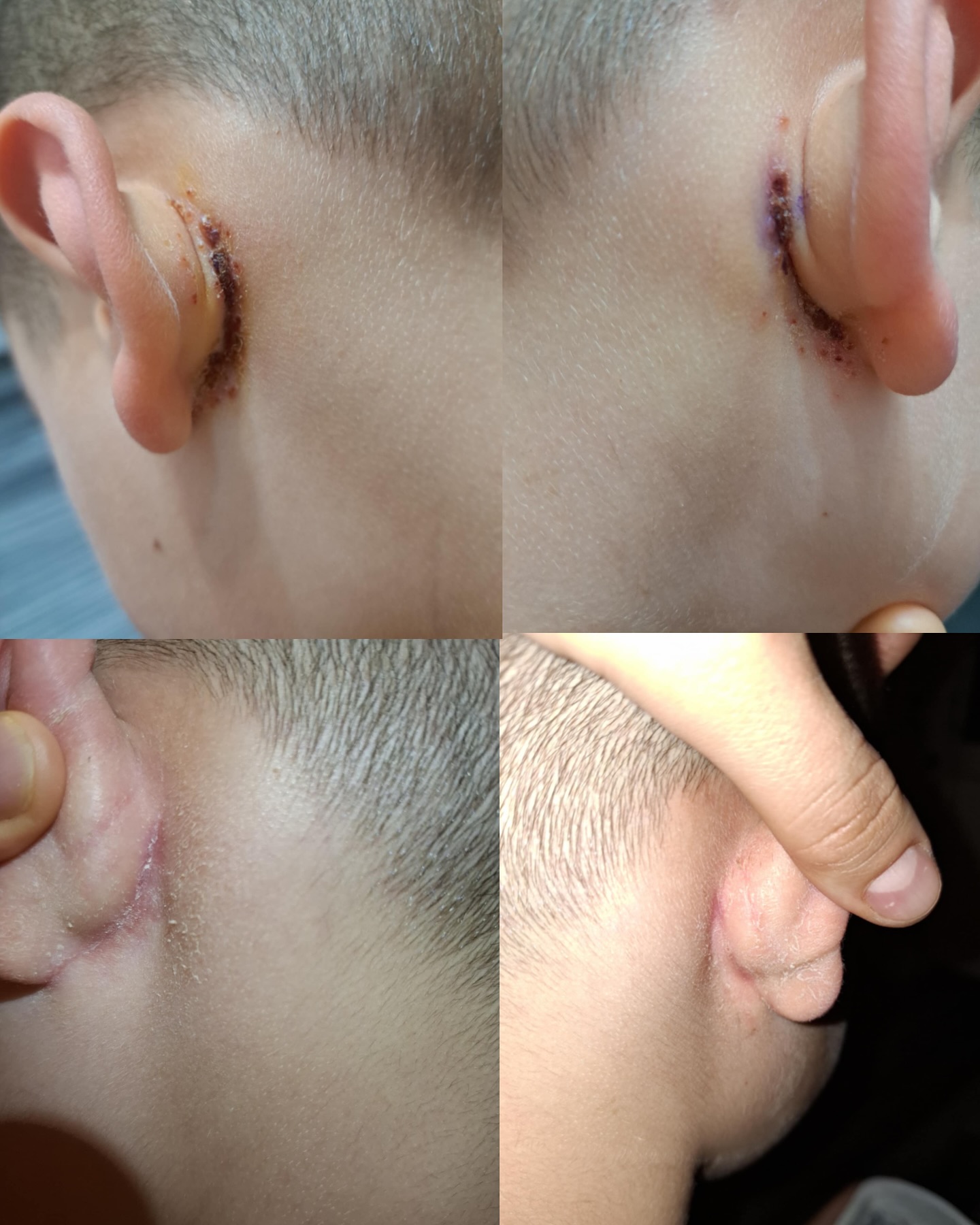 Dr. Alexandra Chirea Bocîrnea, despre intertrigo retroauricular la ...